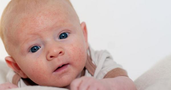 Saiba qual a melhor estratégia para combater a dermatite atópica em ...